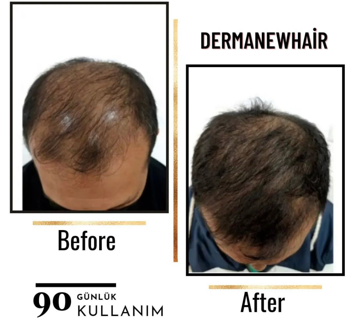 DermaNewHair