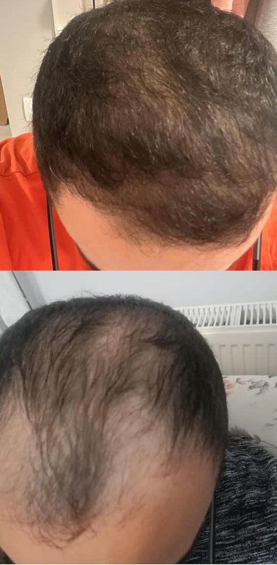 DermaNew Hair growth serum 50 ml – DermaNewHair